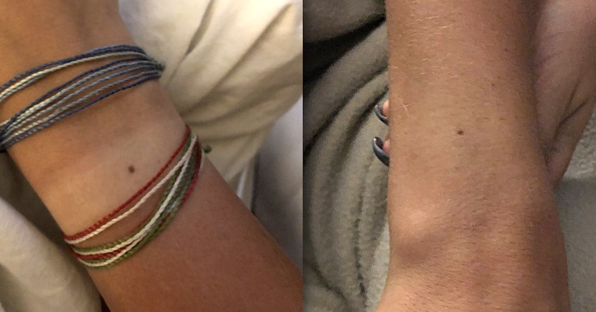 Women are sharing photos of the same freckle they have on their wrist