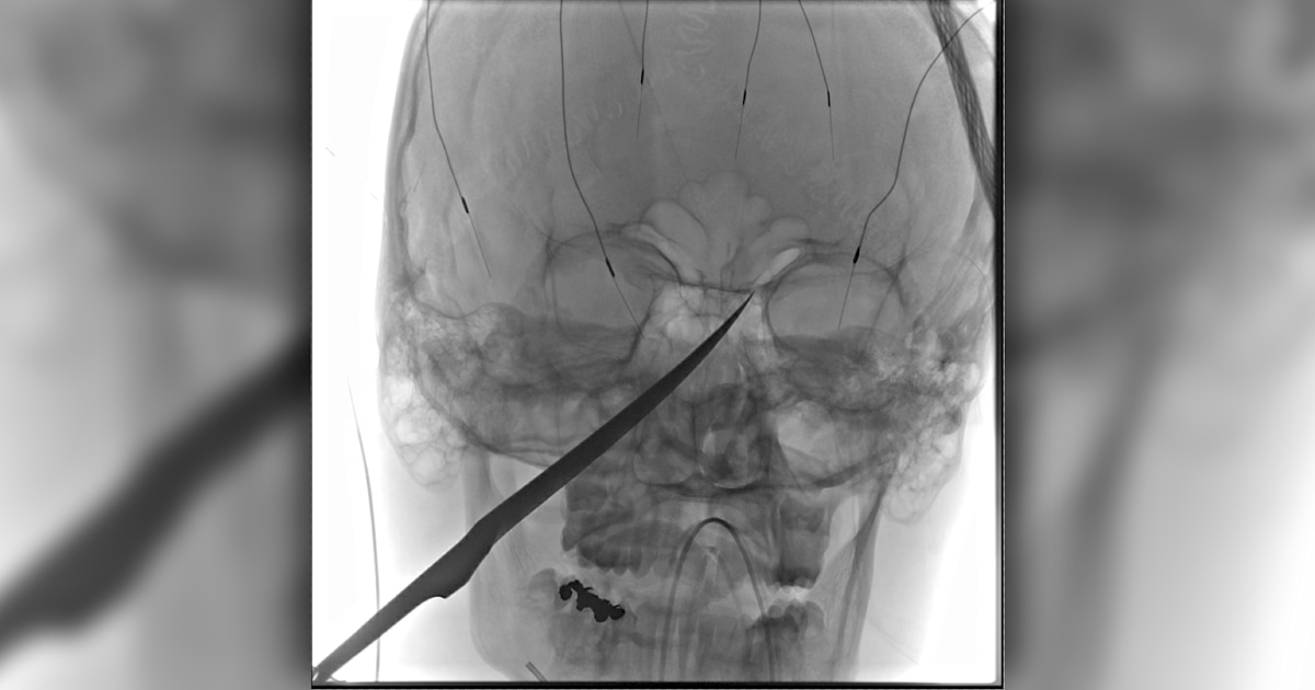 Kansas boy survives 10-inch knife impalement to his face