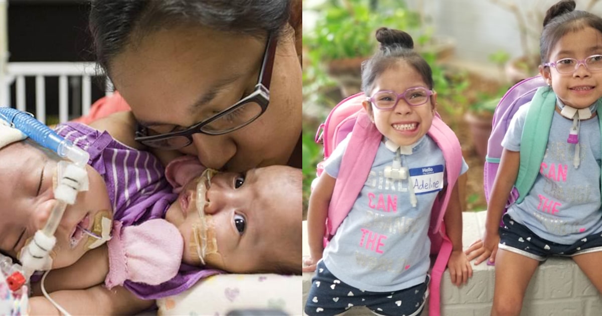 Formerly Conjoined Mata Twins Are Now 5 Start Pre K In Texas Formerly Conjoined Mata Twins Are Now 5 Start Pre K In Texas