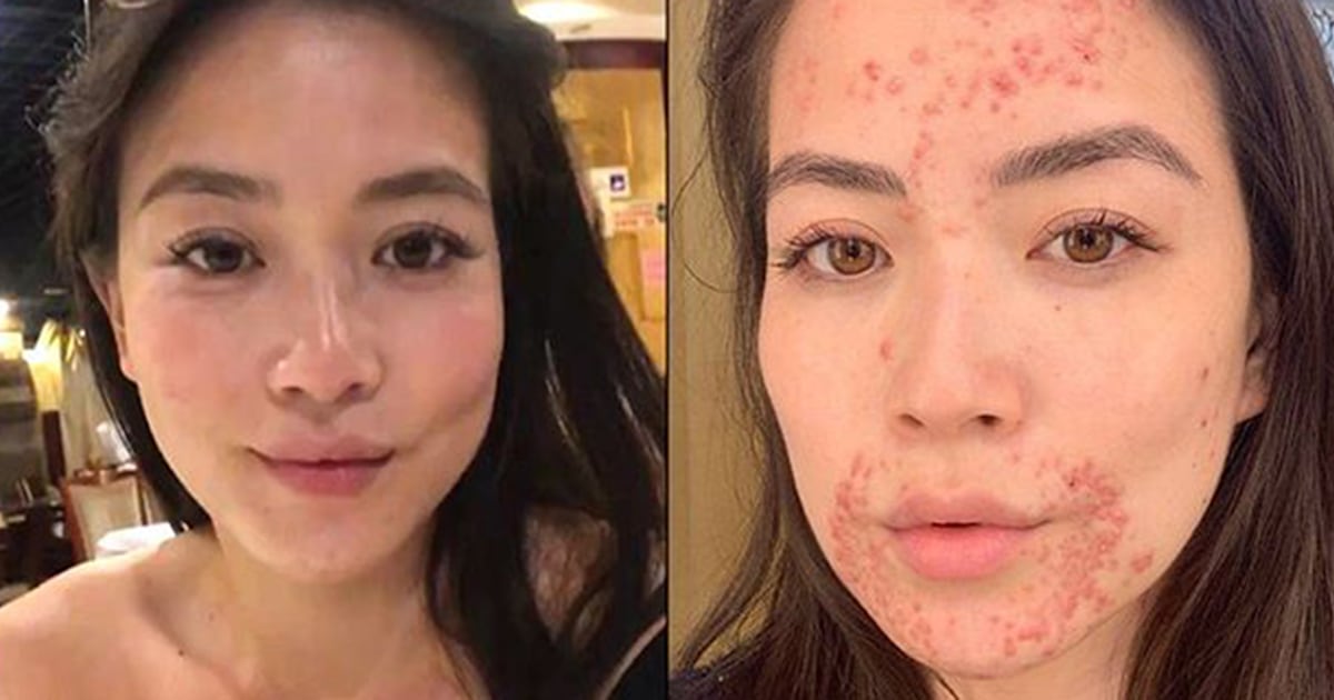 TV anchor Frances Wang opens up about painful skin condition