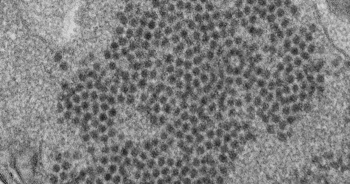 What is AFM? A virus is to blame for polio-like paralysis