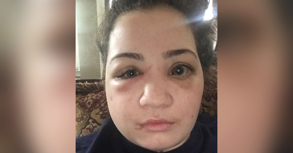 Woman ruptured eyes, almost blind warns about drunk drivers