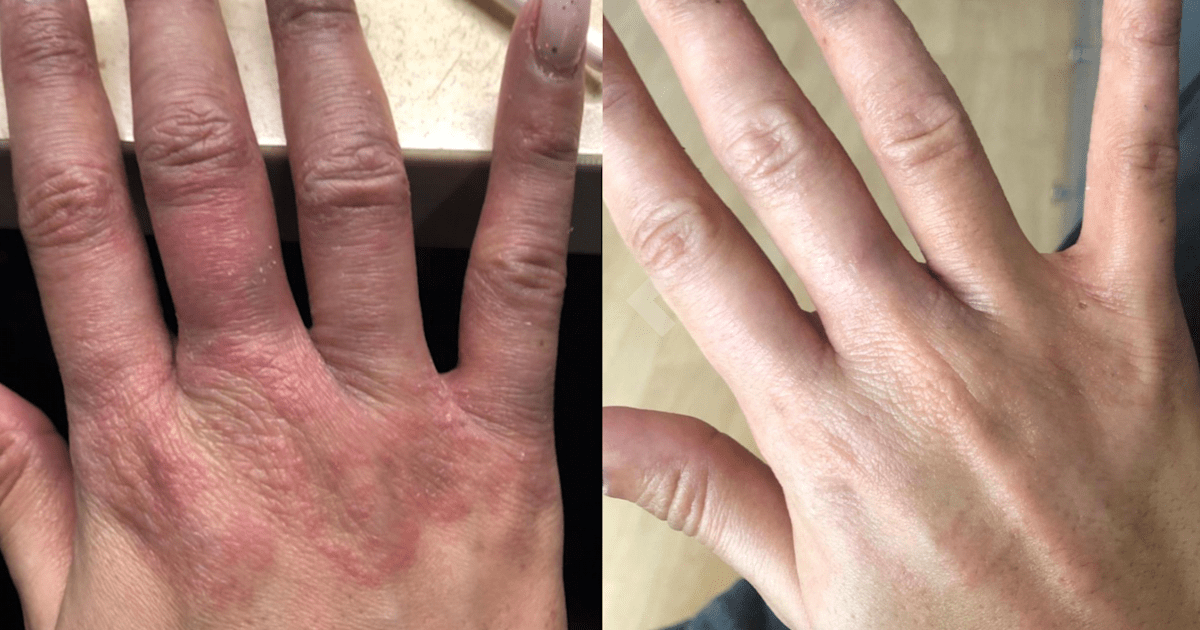 Ease irritating itching with this $5 dermatologist-approved lotion