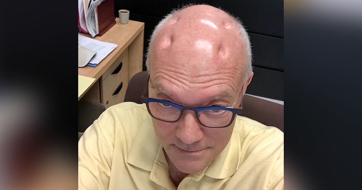 Brain surgery leaves man struggling with self-image: 'You don’t ...