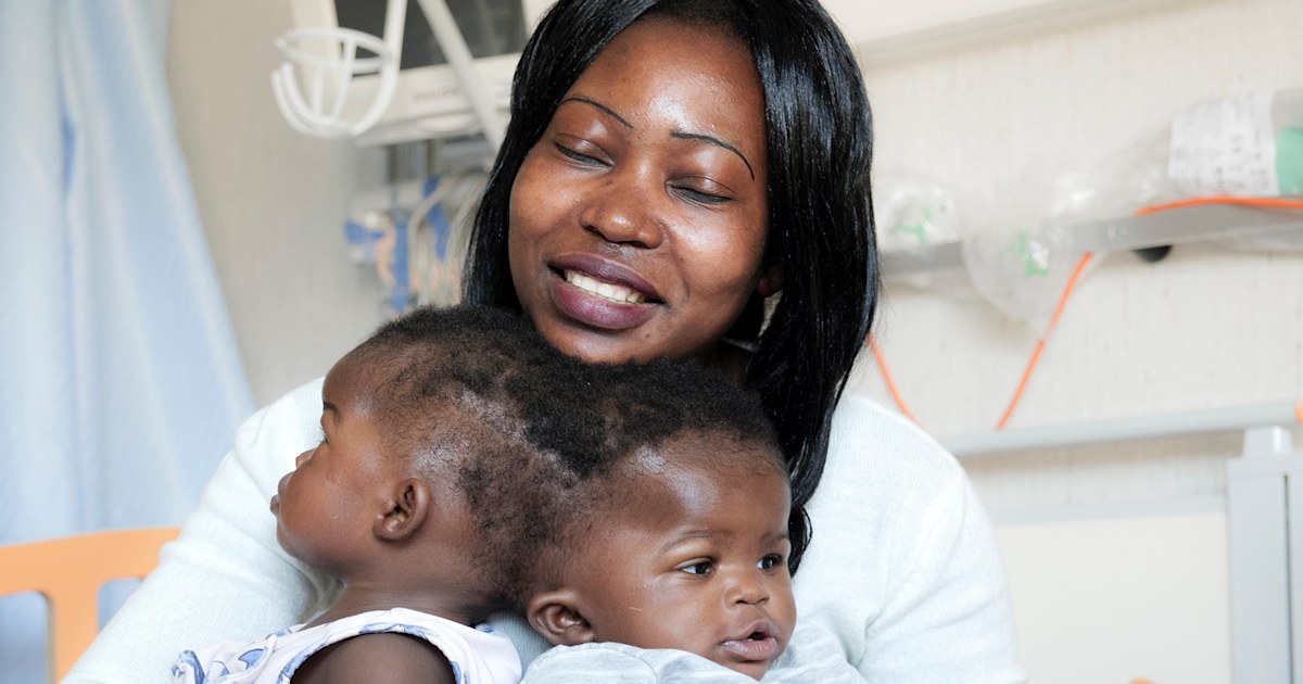 Conjoined craniopagus twins successfully separated in Italian hospital