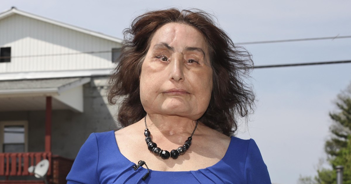 Connie Culp, 1st face transplant recipient in the US, dies at 57