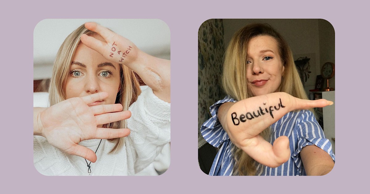 The Witches movie: People with limb difference respond