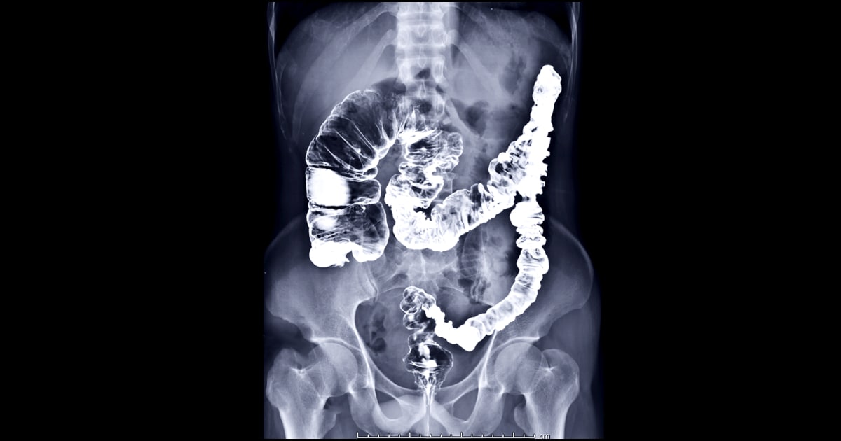 New guidelines: Colorectal cancer screenings to begin at 45