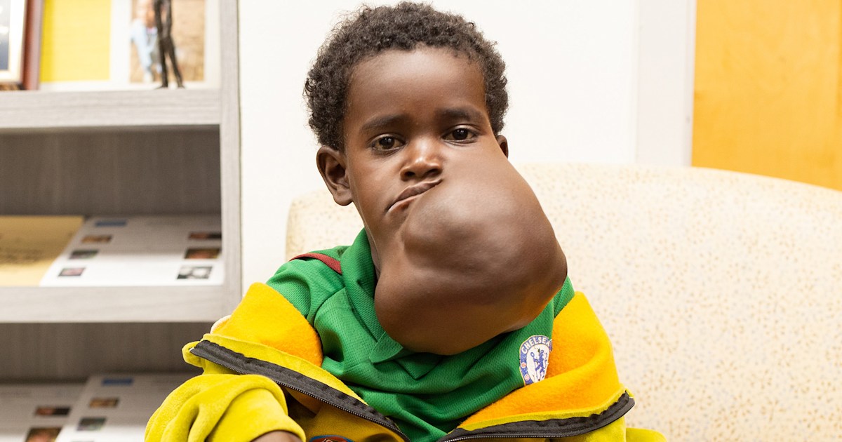 Doctors remove mass from 5-year-old's face in long surgery