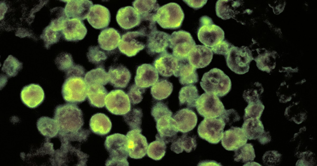 Beach in Iowa closed after rare case of “brain eating amoeba” detected