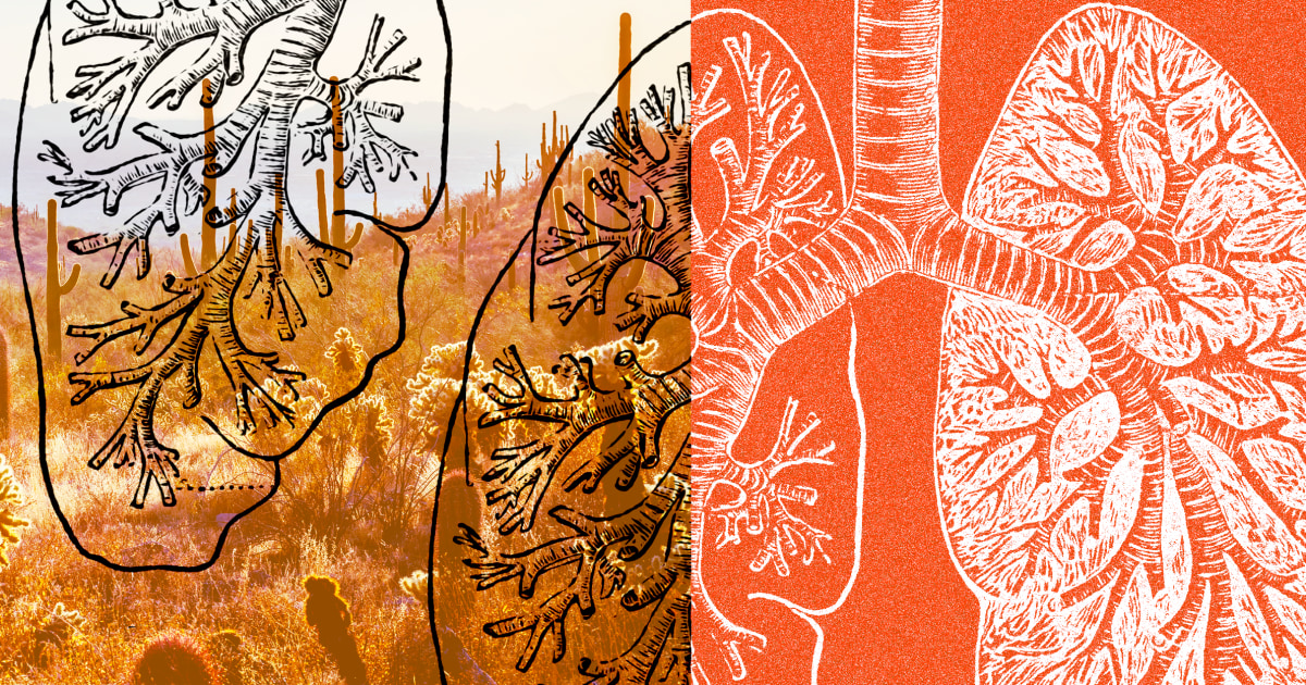 Valley Fever, Historically Found Only in Southwest, Is Spreading, With ...