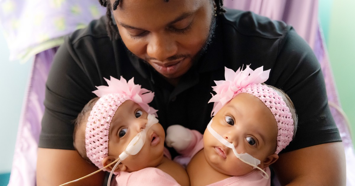 Conjoined twin girls are successfully separated in rare surgery | Flipboard Conjoined twin girls are successfully separated in rare surgery | Flipboard
