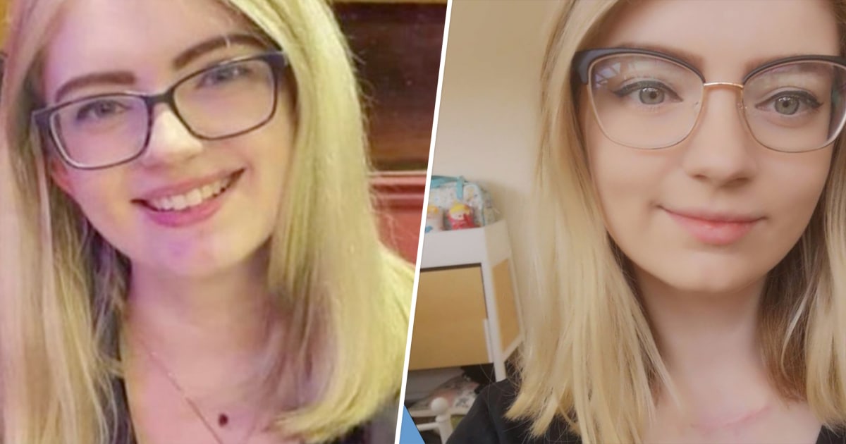 Skin Cancer Symptoms From Woman, 21, Diagnosed When Mole Became Melanoma