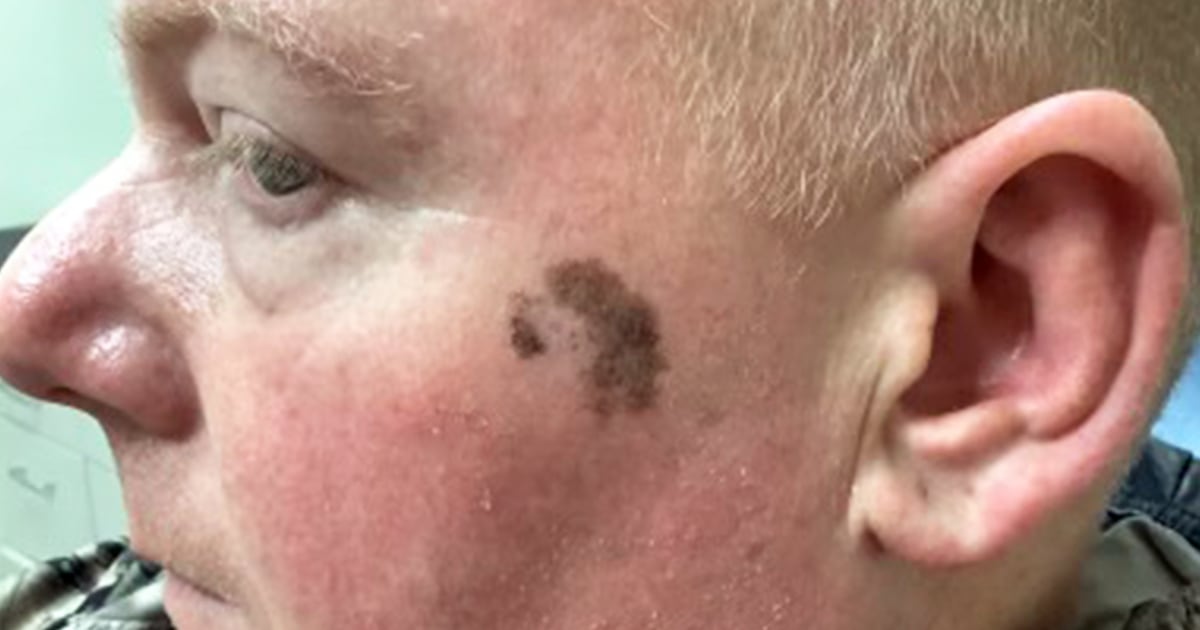 Man's Skin Cancer Diagnosed After Doctor On Train Sees Melanoma Symptoms