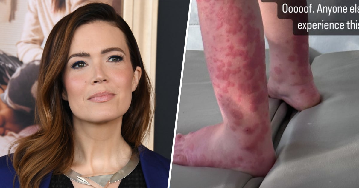 What Is Gianotti-Crosti Syndrome? Mandy Moore Shares Son's Diagnosis On Instagram