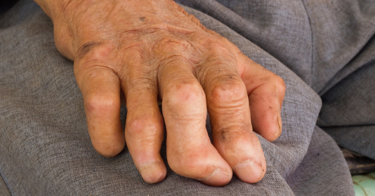 Leprosy in Florida: What to know About Cases on the Rise