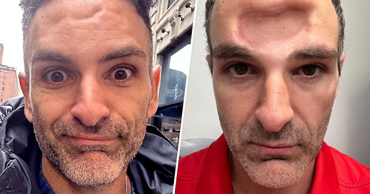 Man With Fibrous Dysplasia, Tumors In Skull Has Reconstructive Surgery