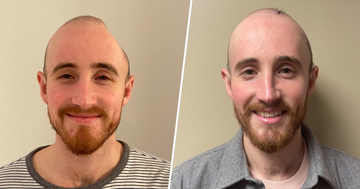 Man Broke Skull After Fall And A 3-D Printed Skull Was The Solution