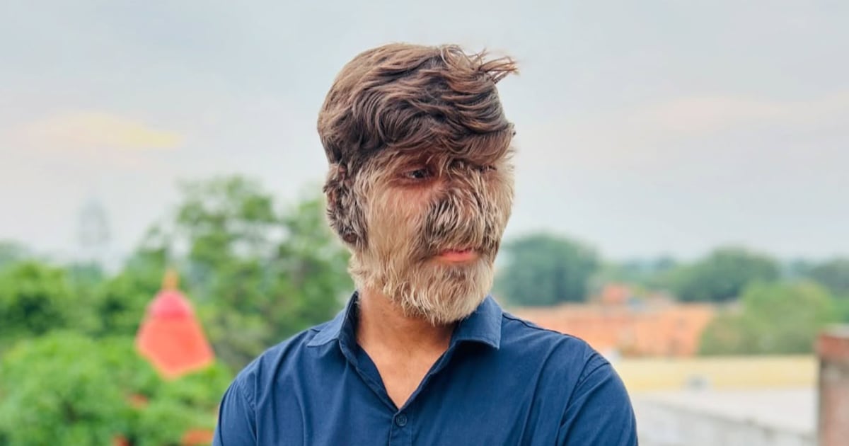 Indian Teenager Sets Guinness World Record Title For Hairiest Face