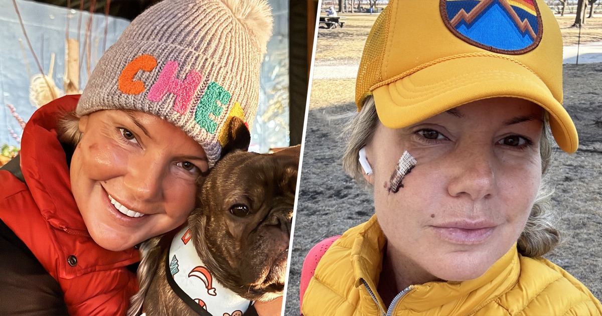 Woman, 43, Shocked When Melanoma Skin Cancer Grows On Face