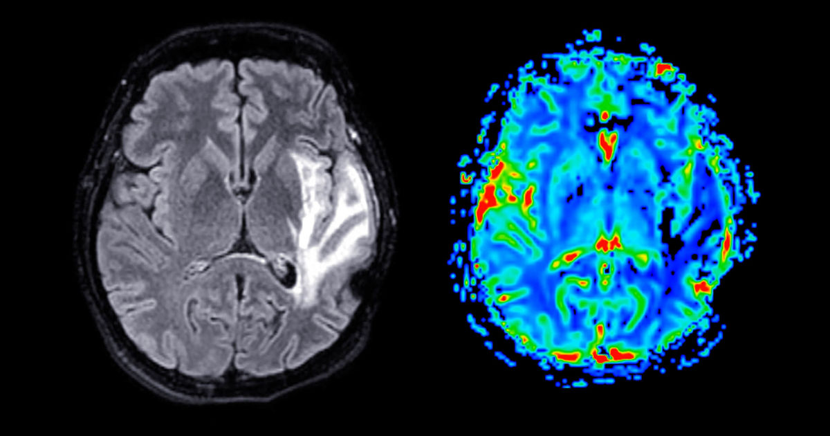 NYC Shooting Suspect Shane Tamura Had CTE Concerns. What Is It?