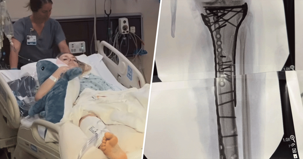 Lindsey Vonn Says She's 'Struggling,' Shares X-Ray of Leg After Injury