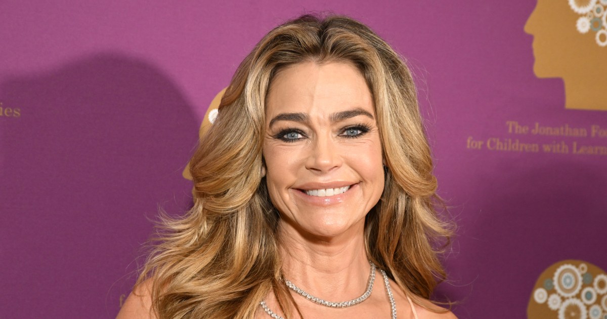Denise Richards Shares Facelift Before and After Photos