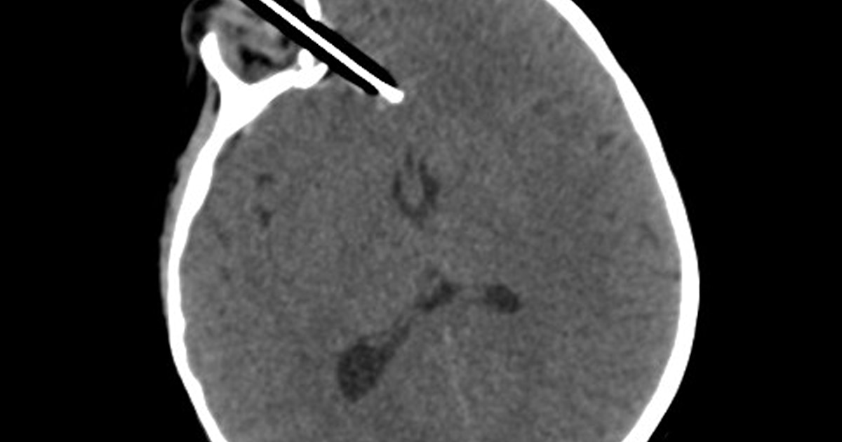 Toddler survives pencil in brain