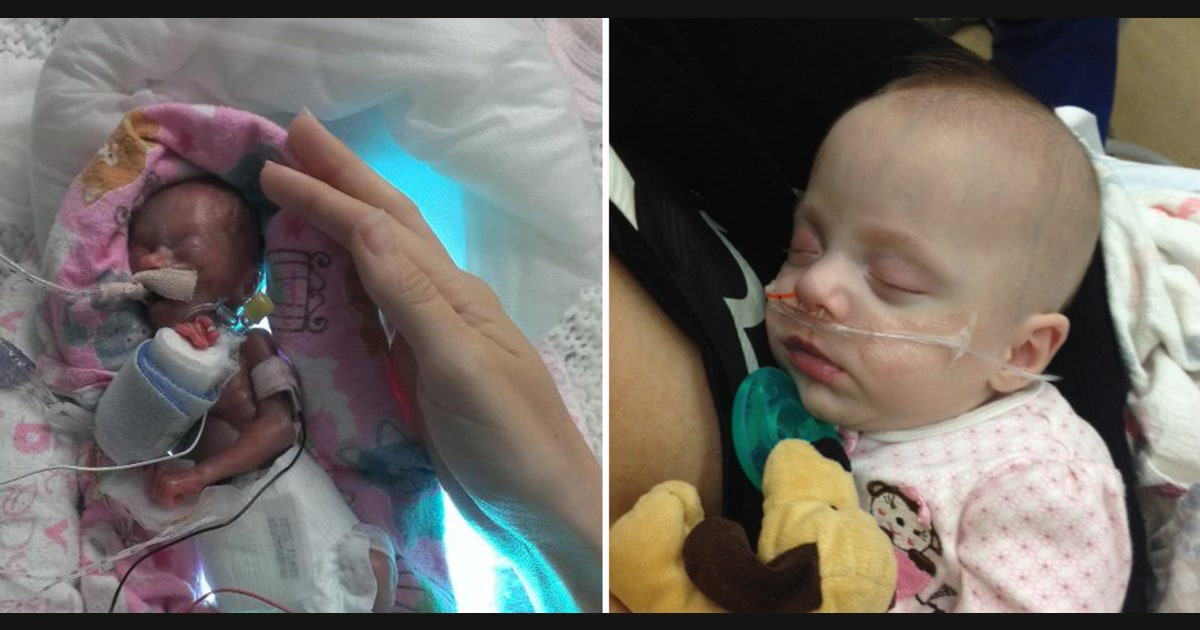 More tiny preemies survive, but may face lifelong challenges