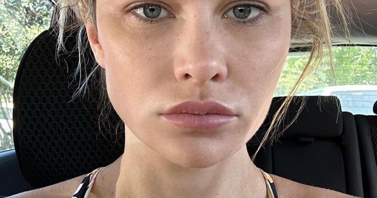 Bachelor Nation’s Megan Marx Shares Rare Brain Disorder Diagnosis